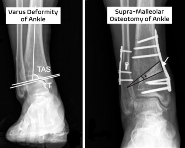 Ankle Osteotomy – Dr Roy Joint Clinic